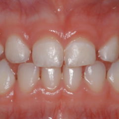 Frontzahn - DocCheck Flexikon