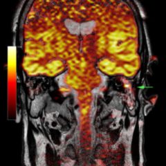 Cholesteatom - DocCheck Flexikon