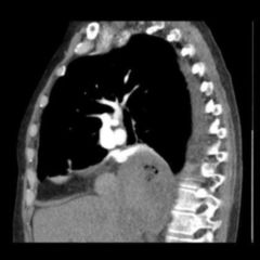 Fundoplikatio - DocCheck Flexikon