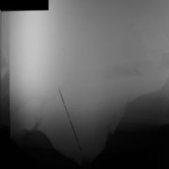 Descensus uteri - DocCheck Flexikon