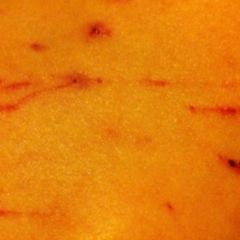Schürfwunde - DocCheck Flexikon