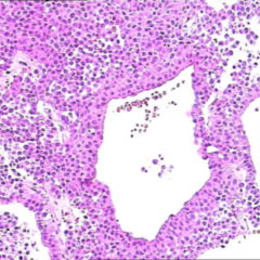 Hypophysenadenom - DocCheck Flexikon