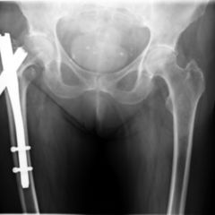 Dislokation - DocCheck Flexikon