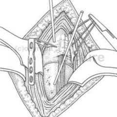 Wertheim-Meigs-Operation - DocCheck Flexikon