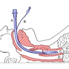Intubation - DocCheck Flexikon