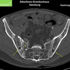 Osteolyse - DocCheck Flexikon