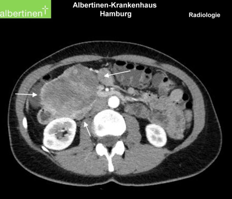 GIST CT axial - DocCheck