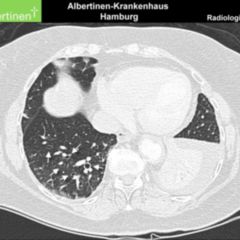 Bronchiektase - DocCheck Flexikon