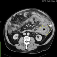 Burkitt-Lymphom - DocCheck Flexikon