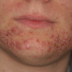 Acne papulopustulosa - DocCheck Flexikon