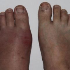 Podagra - DocCheck Flexikon