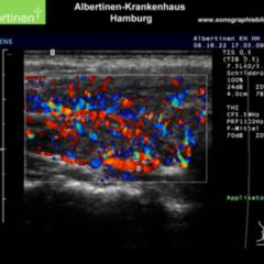 Morbus Basedow - DocCheck Flexikon