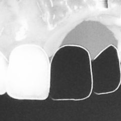Hungry-Bone-Syndrom - DocCheck Flexikon