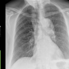 Bronchiektase - DocCheck Flexikon