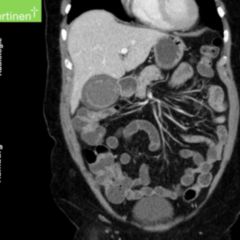 Cholezystitis - DocCheck Flexikon