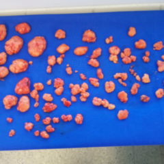 Lipom - DocCheck Flexikon