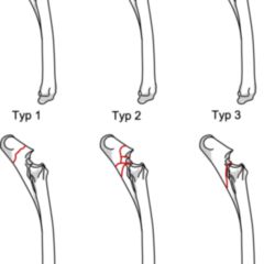 Ulnafraktur - DocCheck Flexikon