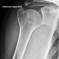 Tuberculum majus humeri - DocCheck Flexikon