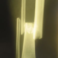 Offene Fraktur - DocCheck Flexikon