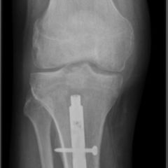 Tibial - DocCheck Flexikon