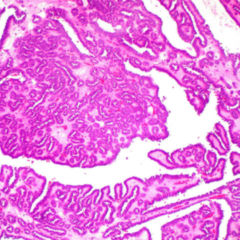 Adenom - DocCheck Flexikon