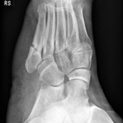 Jones-Fraktur - DocCheck Flexikon