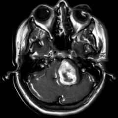 Porus acusticus internus - DocCheck Flexikon