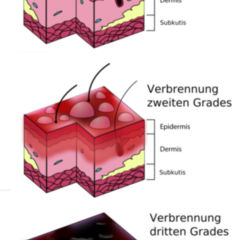 Verbrennungsgrad - DocCheck Flexikon