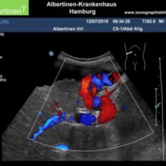 Plica umbilicalis mediana - DocCheck Flexikon