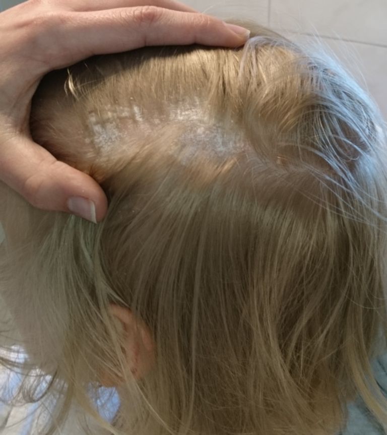 Psoriasis capitis / Schuppenflechte Kopfhaut (7) - DocCheck