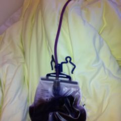 Purple Urine Bag Syndrome - DocCheck Flexikon