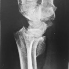 Distale Radiusfraktur - DocCheck Flexikon