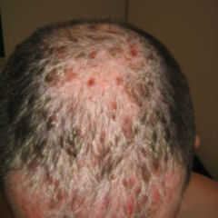 Psoriasis capitis - DocCheck Flexikon