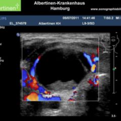Einblutung - DocCheck Flexikon