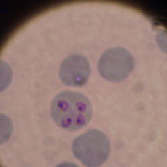 Borrelien-Lymphozytom - DocCheck Flexikon