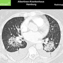 Peribronchial - DocCheck Flexikon