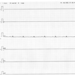 Asystolie - DocCheck Flexikon