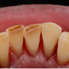 Zahnbelag - DocCheck Flexikon