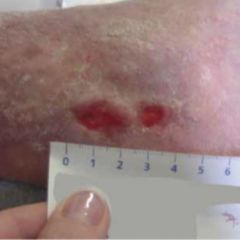 Malum perforans - DocCheck Flexikon