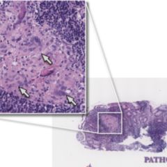 Langhans-Riesenzelle - DocCheck Flexikon