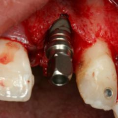 Ankylose - DocCheck Flexikon