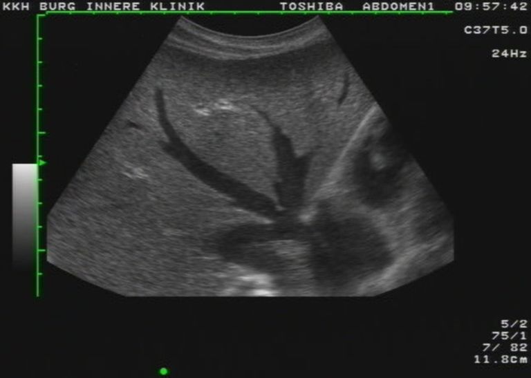 Gestaute Lebervenen - DocCheck