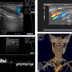 Pfropf-Polyarthritis - DocCheck Flexikon