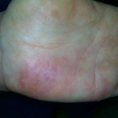 Palmar - DocCheck Flexikon