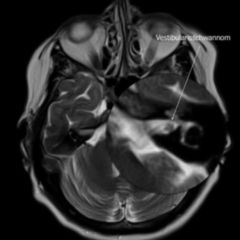 Plica vestibularis - DocCheck Flexikon