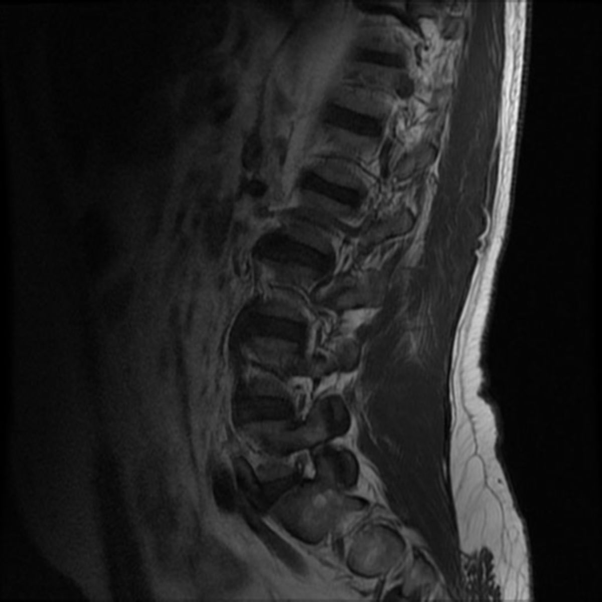 MRI Lendenwirbelsäule - DocCheck