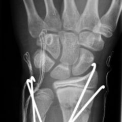 Ulnafraktur - DocCheck Flexikon