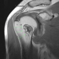 Metaphyse - DocCheck Flexikon