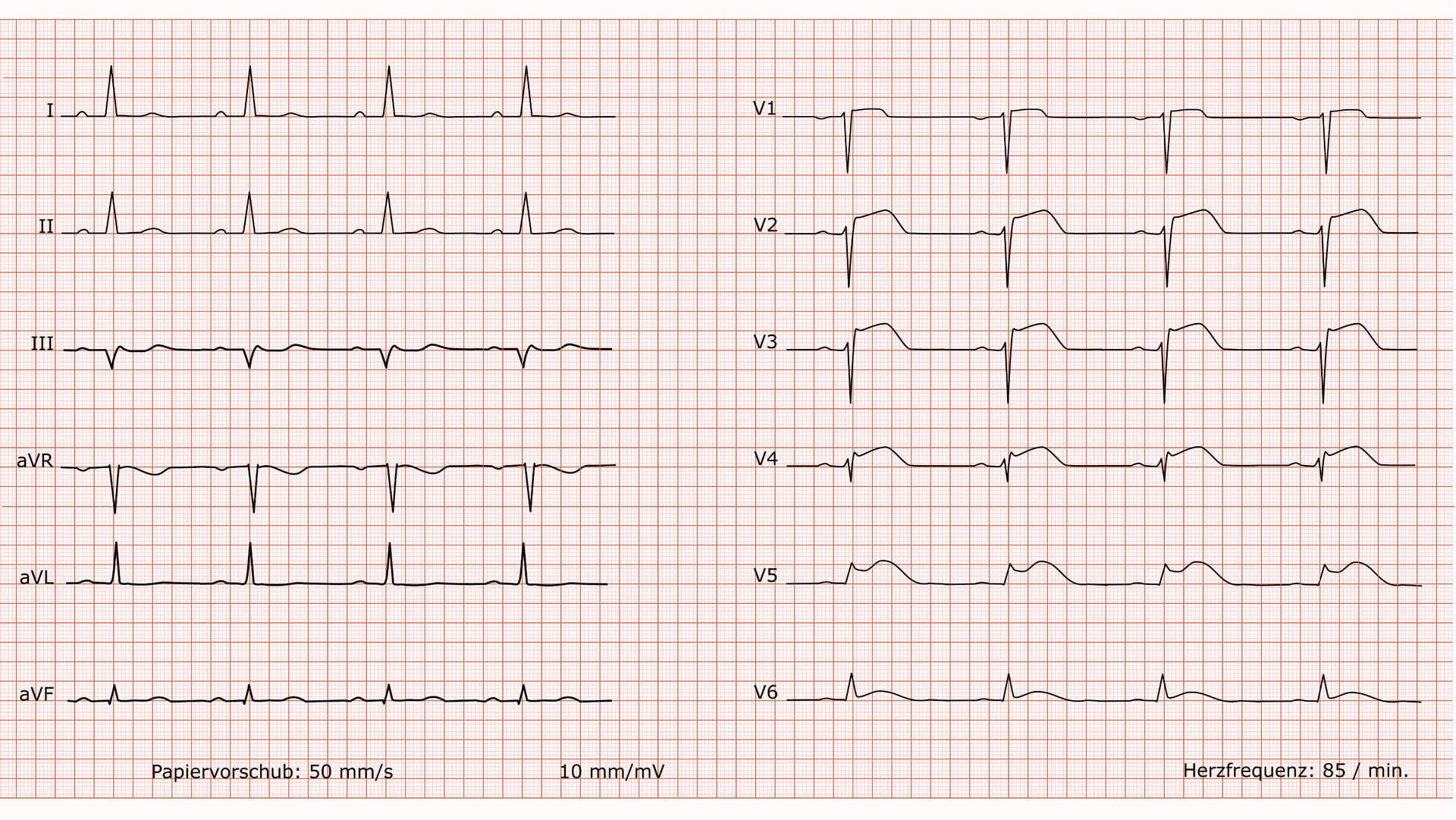 12-Kanal-EKG bei Vorderwandinfarkt - DocCheck