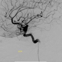 Ramus marginalis sinister - DocCheck Flexikon